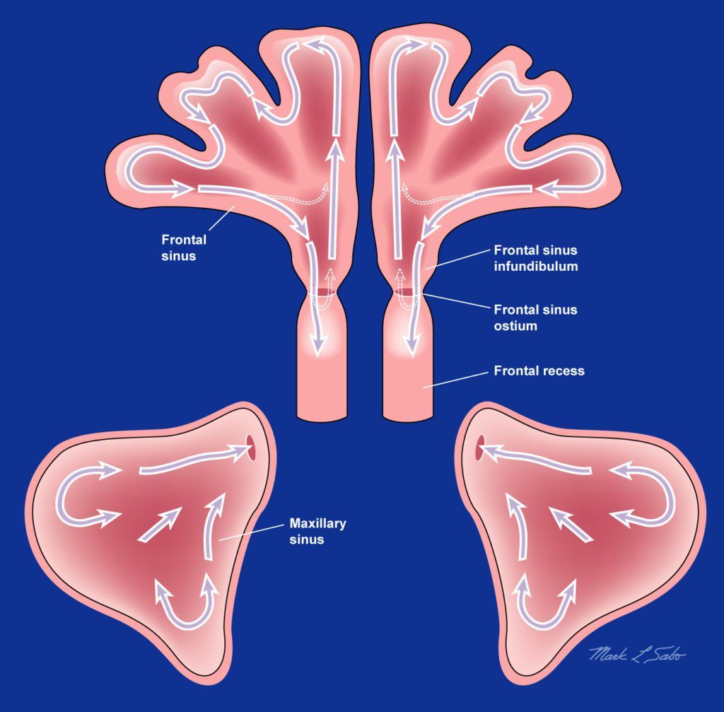 Cirugía para la Sinusitis - La Clínica de Rinosinusitis LLCSan Juan, PR ...
